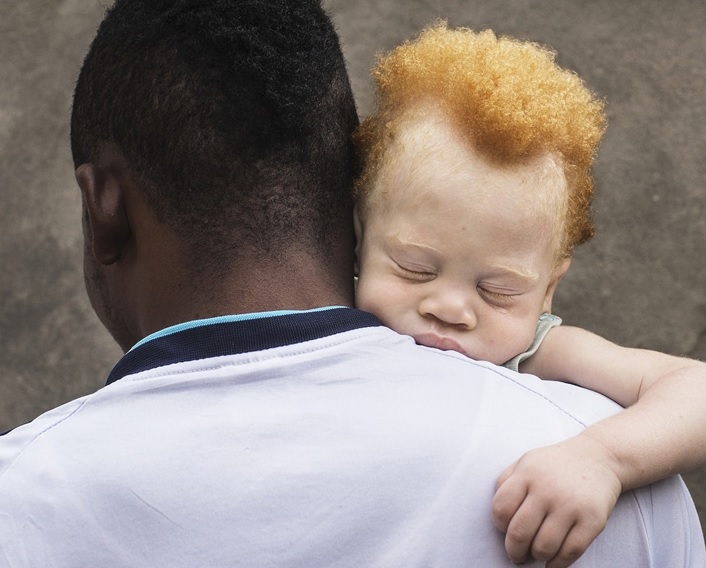 13 iunie, ziua de conștientizare a albinismului : Europa FM