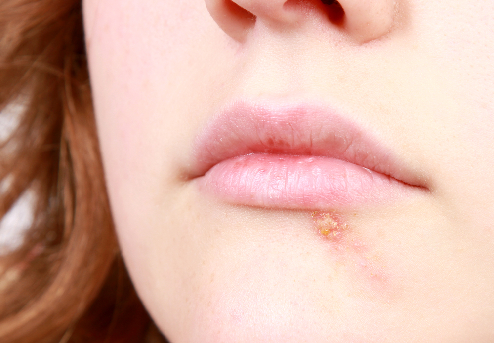 Herpes Simplex – Virusul Herpetic : Europa FM