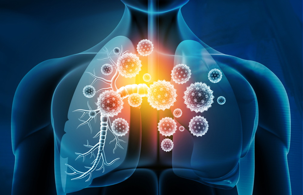 Minutul de Sănătate: Astmul sever eozinofilic – simptome și diagnostic ...