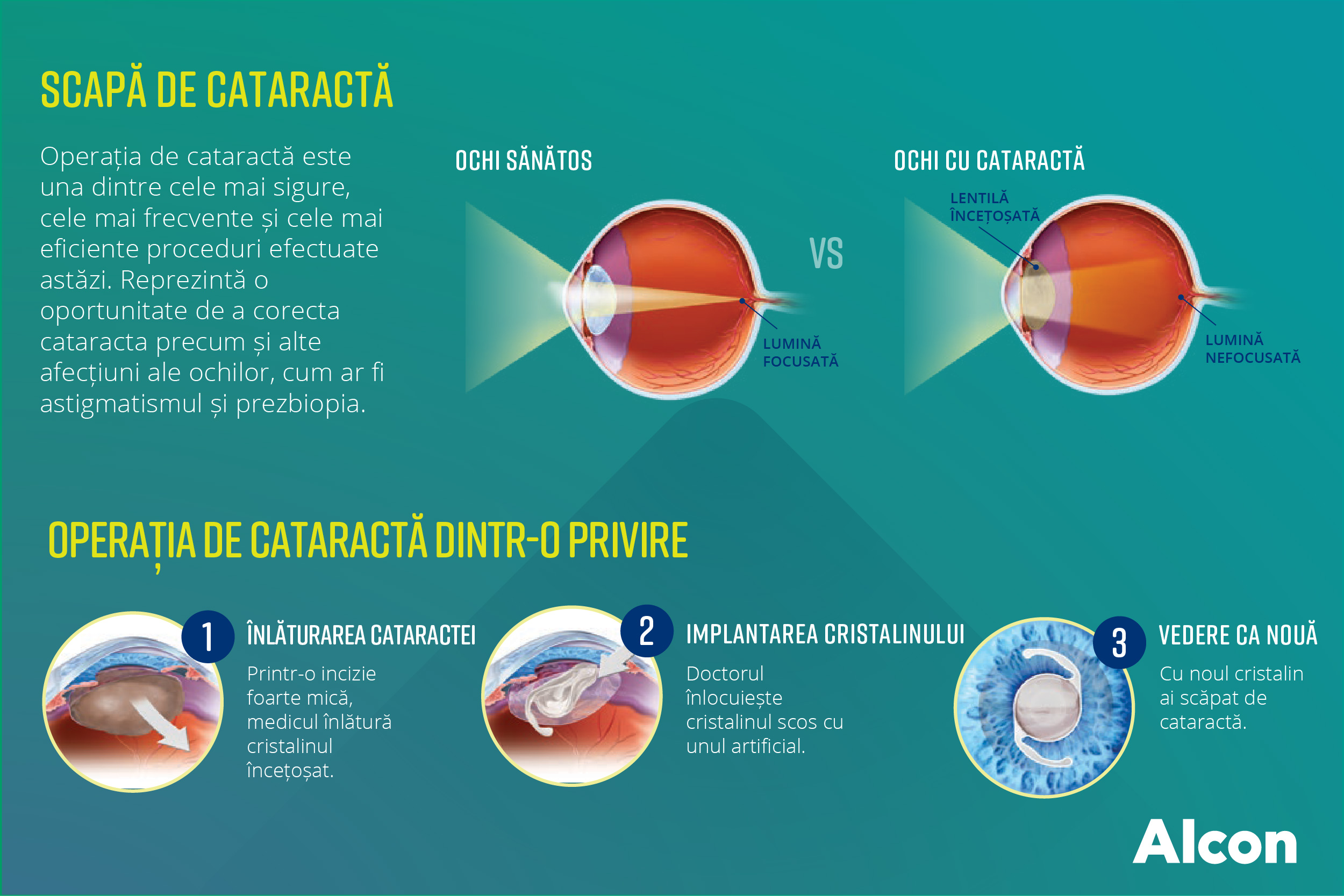 Minutul de sănătate: Luna de conștientizare a cataractei – Cum tratăm ...