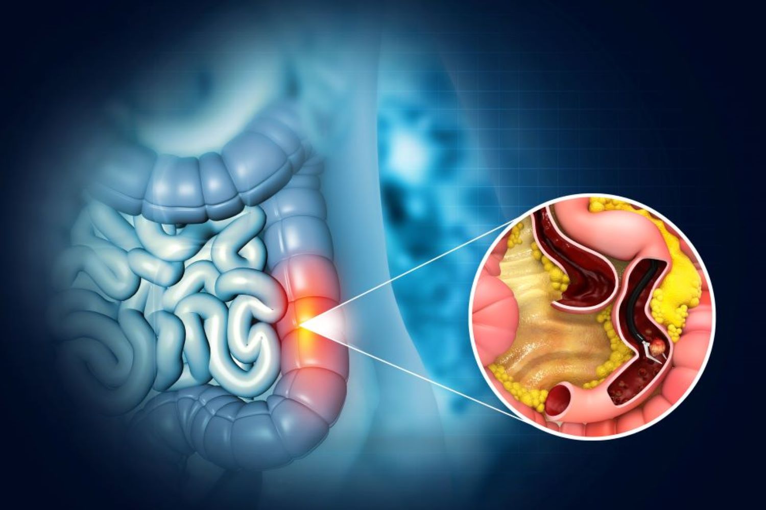 Polipii colonici: de ce apar, cum se manifestă și cum pot fi ...
