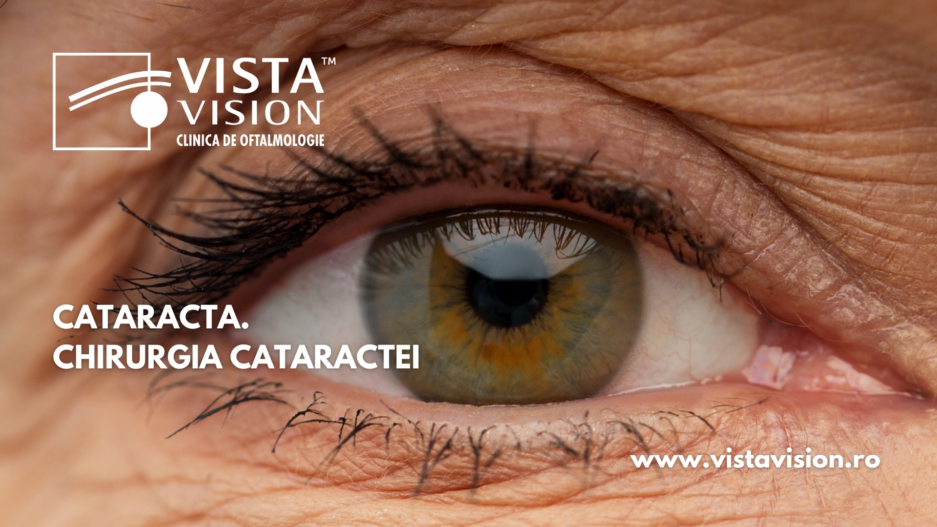 Minutul de Sănătate: Cataracta. Chirurgia cataractei | AUDIO : Europa FM